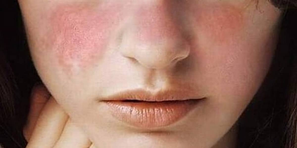 Lúpus eritematoso sistêmico: o que é, sintomas e tratamento