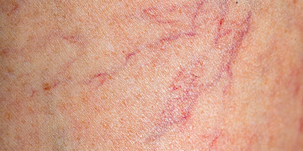 Vasculites: entenda o que são, tipos, sintomas e tratamento.