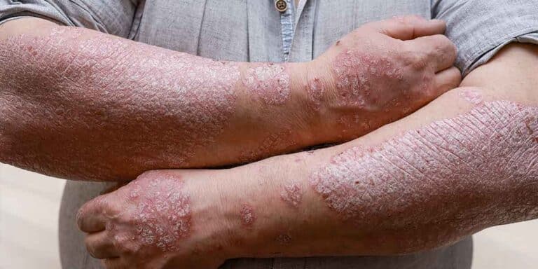 Artrite psoriática: saiba mais sobre esta doença reumática.