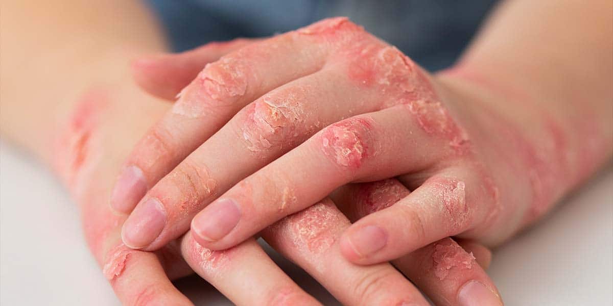 Artrite psoriática: saiba mais sobre esta doença reumática.